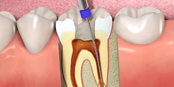 Safe Root Canal Treatment | Dr. Thareja’s Dental Clinic